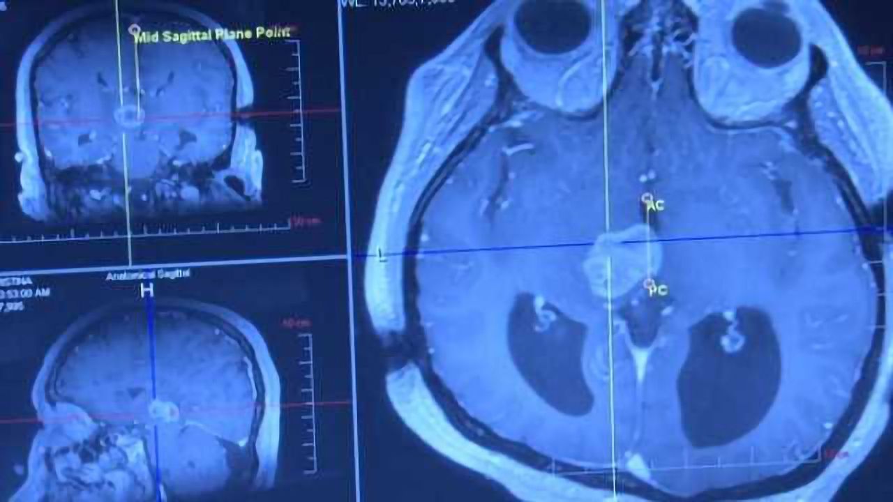 MRI-Guided Biopsy for Brain Cancer Improves Diagnosis | Technology Networks