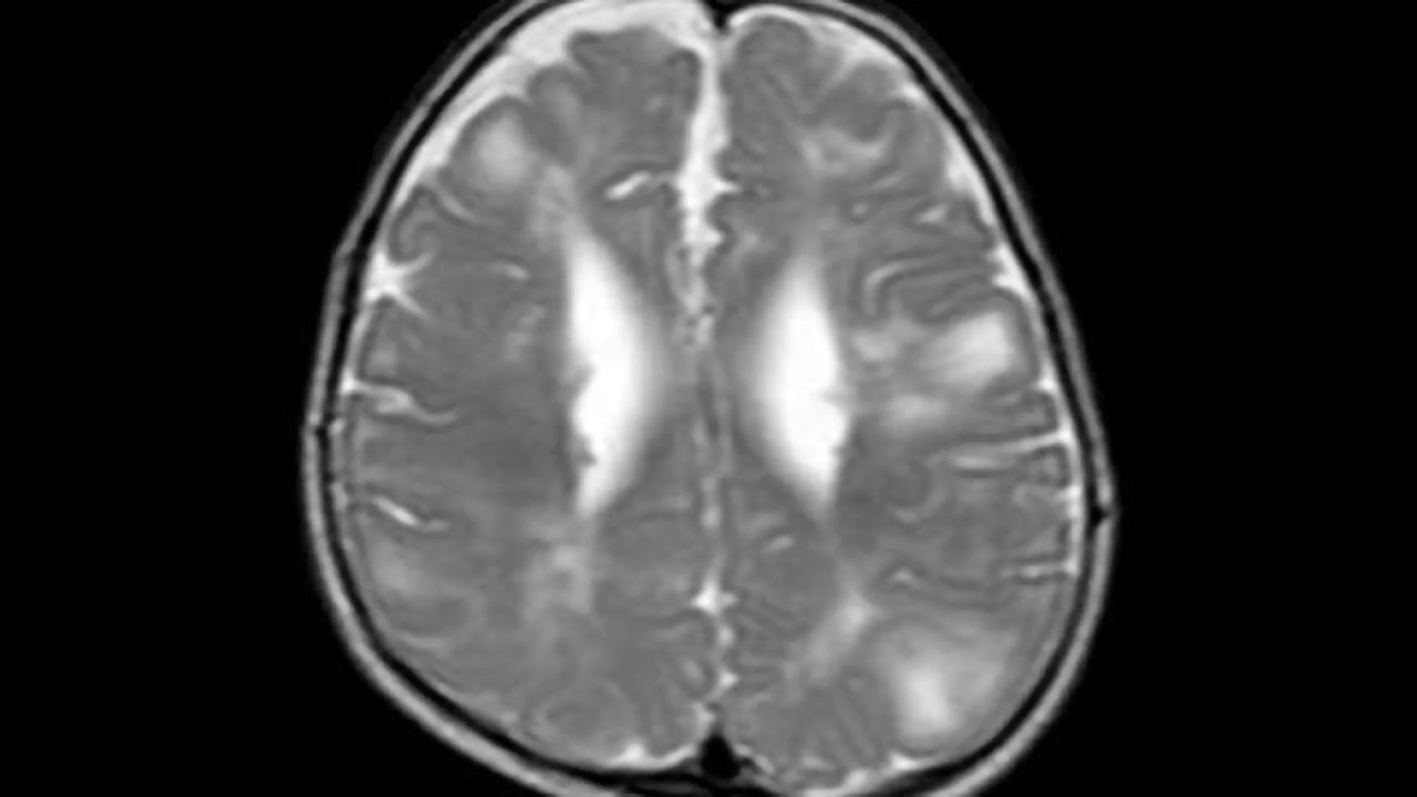 Children with tuberous sclerosis complex (TSC) genetic tumor disorder ...