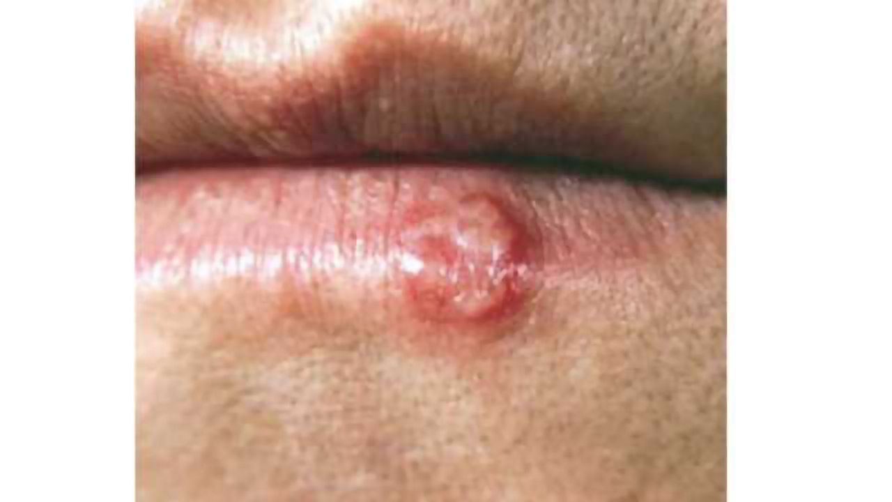 Cold sore virus increases the risk of dementia | Technology Networks