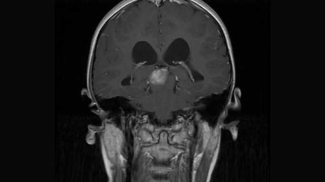 Direct Evidence Found of Gadolinium Deposition in Brain Tissues ...