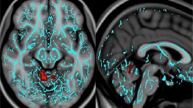 Concussion Brain Compared To Normal