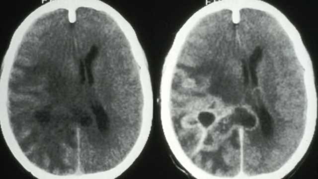 Improved survival in adult patients with low-grade brain tumors ...