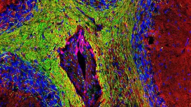 Brain cell death is a possible trigger of multiple sclerosis ...