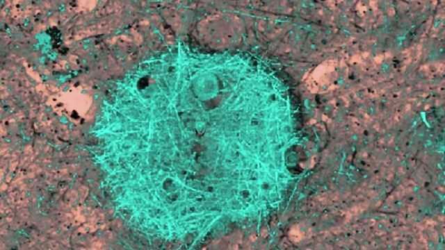 Researchers identify 'neurostatin' that may reduce the risk of ...