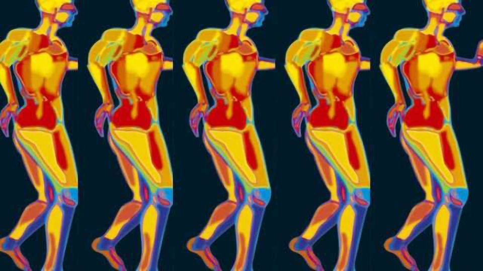 Implanted neuroprosthesis improves walking ability in stroke patient ...