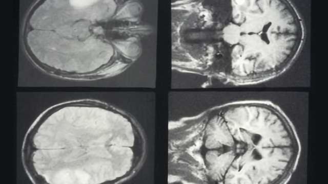 Immune and targeted therapies with radiation therapy improves outcomes ...