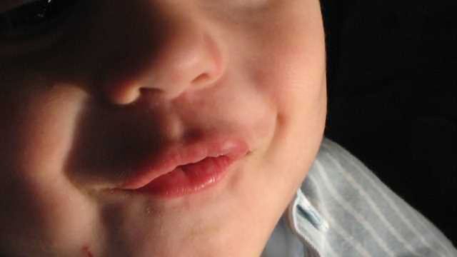 Stuttering related to brain circuits that control speech production ...