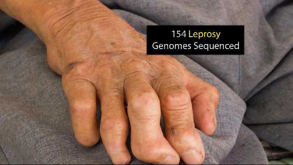 Sequencing of Leprosy Genome Could Provide Vital Answers to Drug ...