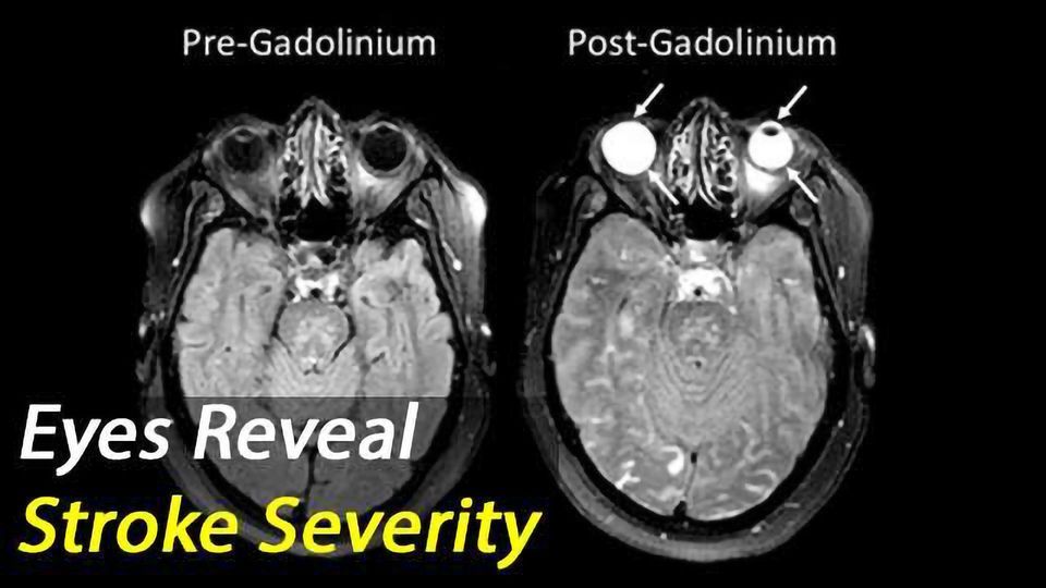 Eye Could Provide “Window to the Brain” After Stroke | Technology Networks