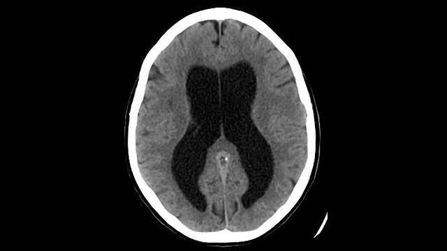 Understanding Brain’s Water System May Prove Beneficial in Stroke ...