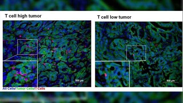 Revealing Secrets of 'Hot' & 'Cold' Pancreatic Cancer Tumors ...