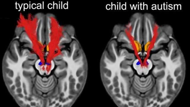 Key Social Reward Circuit in the Brain Impaired in Kids With Autism ...