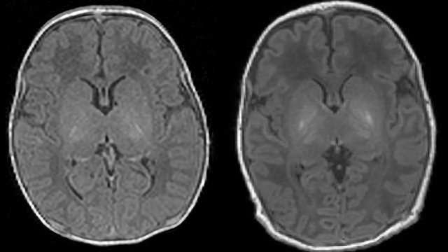 Determining the Likelihood of Long-term Brain Damage in Newborns ...