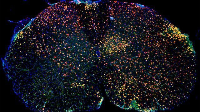 Neuroinflammatory Cell Atlas Could Aid Multiple Sclerosis Therapies ...