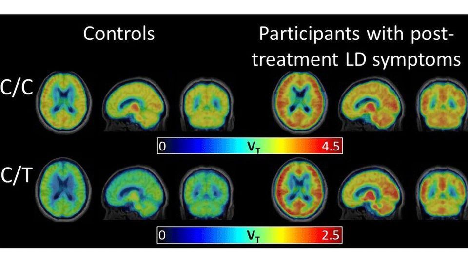 Widespread Brain Inflammation Revealed in Post-treatment Lyme Disease ... Widespread Brain Inflammation Revealed in Post-treatment Lyme Disease ...