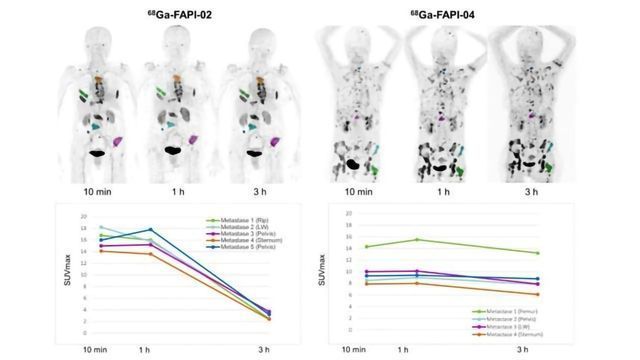 Two New Tracers Improve Diagnosis of Cancer | Technology Networks