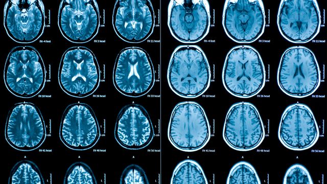 Non-contrast MRI Proves Effective in Monitoring MS Patients ...