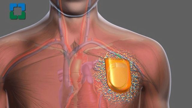 Absorbable Antibiotic Envelope Can Cut Cardiac Device Infections ...