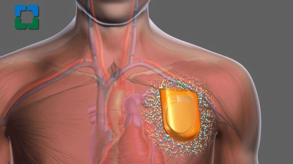 Absorbable Antibiotic Envelope Can Cut Cardiac Device Infections ...