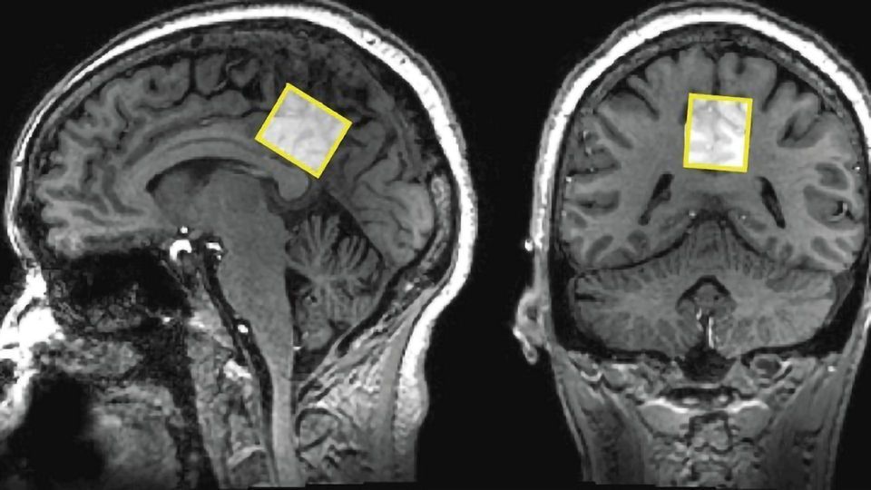 Mild Cognitive Impairment and Signaling Explored With MRS Scan ...