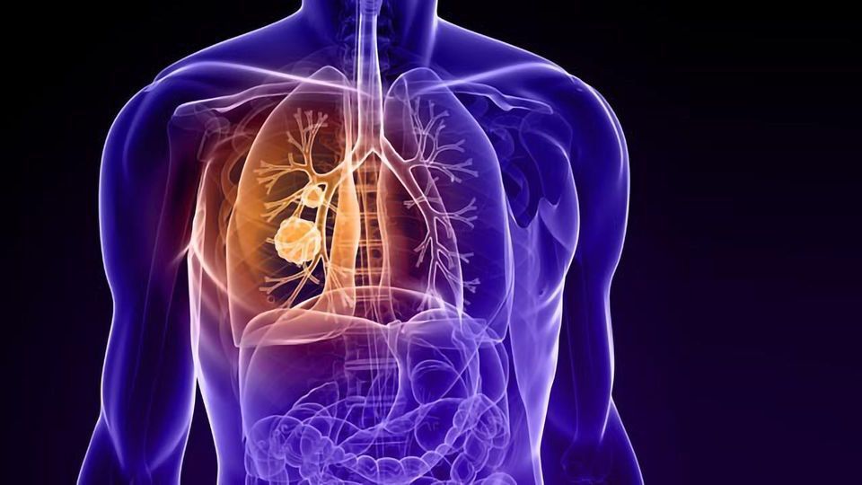 Diagnosing Lung Cancer With Artificial Intelligence | Technology Networks