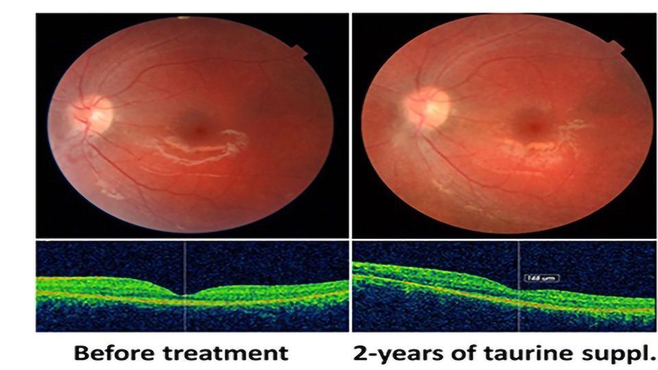 Progression of Eye and Cardiac Disease Halted by Food Supplement ...