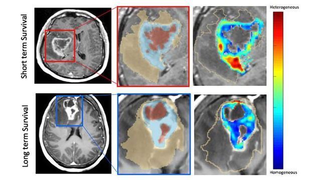 Strategies Developed To Understand and Combat Brain Cancer | Technology ...