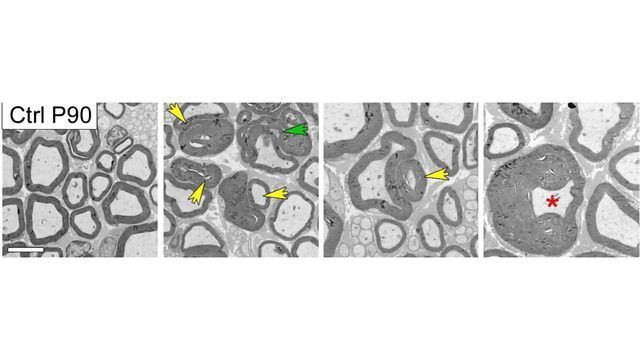Researchers Identify Mechanism Behind Inherited Neuropathy Charcot ...