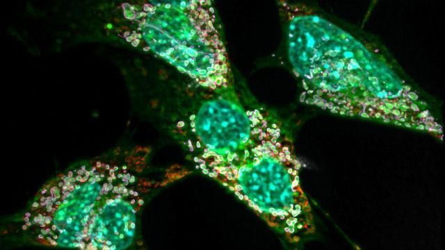 Chronic Inflammation Triggered by Fat Crystals | Technology Networks