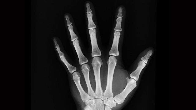 How Inflammation Leads to Bone Erosion | Technology Networks