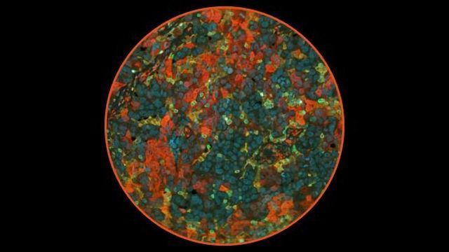 Identifying Platinum Chemotherapy Resistance in Patients With Ovarian ...