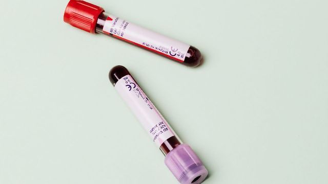 Simple Blood Test Can Accurately Identify Underlying Neurodegeneration ...