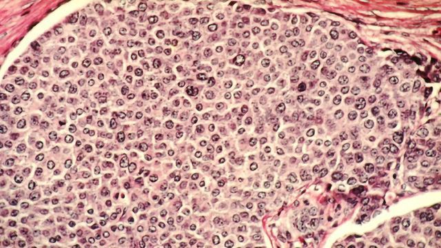 New Approach Kills >95% of Diseased Cells in Mouse Models of Breast ...