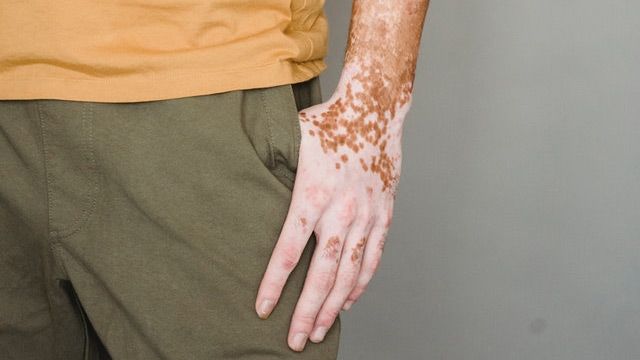 Cellular Mechanisms of Genetic Skin Diseases Uncovered | Technology ...