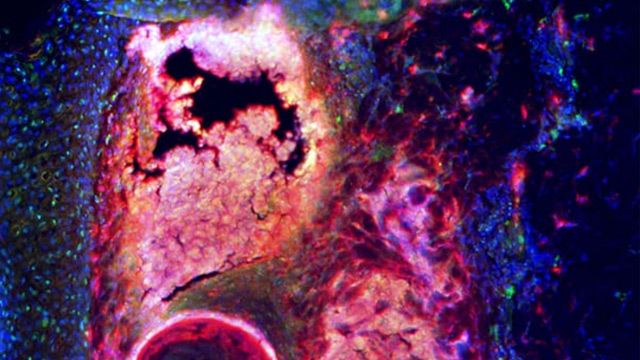 How Fat Cells in the Skin Help Fight Acne | Technology Networks