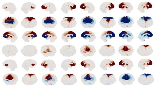 Personalized Brain Models Aim To Improve Depression Treatment ...