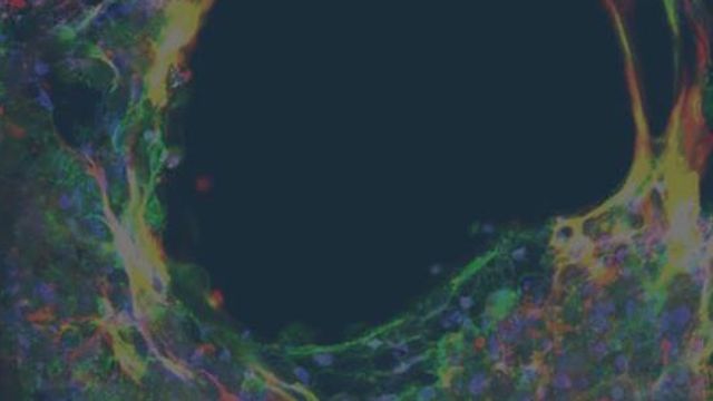 The Dash for NASH: How To Succeed in NASH Therapeutic Development ...