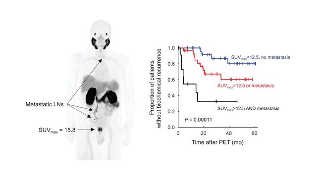 Combined PET and MRI Scans for Prostate Cancer Protein Predict ...