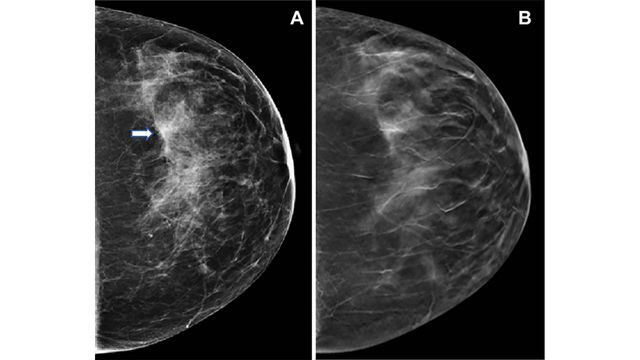 Advanced Imaging Technique Improves Breast Cancer Detection