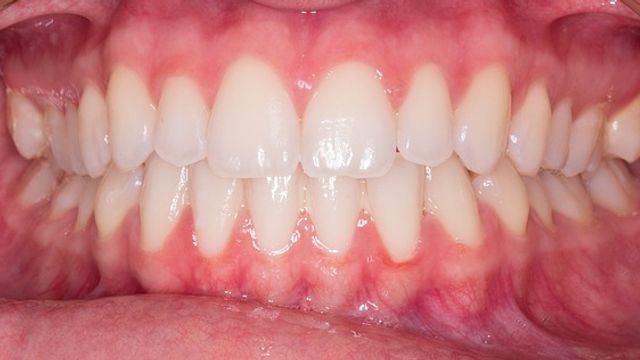 AI Used To Detect Gum Inflammation | Technology Networks