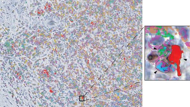 Immune Cell Trio Crucial for Liver Cancer Immunotherapy | Technology ...