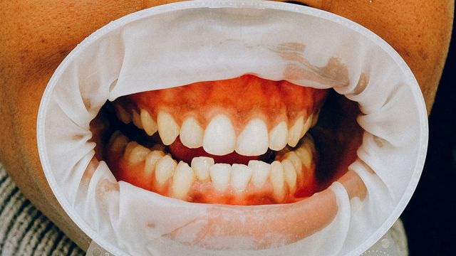 Role of Notch Signaling in the Evolution of Teeth Revealed | Technology ...