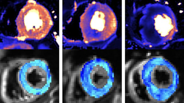 New Scanning Methods Can Detect Deadly Heart Condition Before Symptoms ...