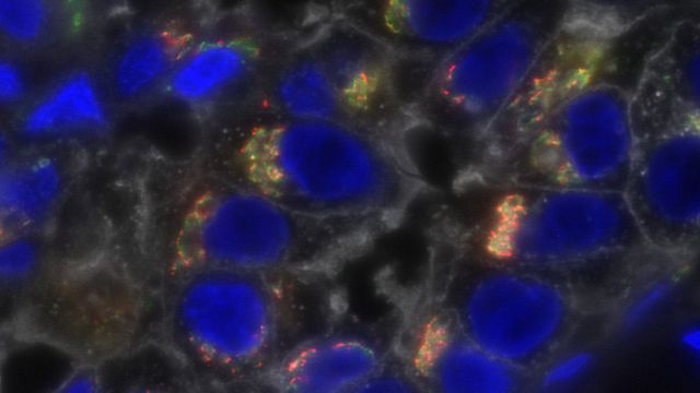 Strategy Developed To Predict Triple-Negative Breast Cancer Therapy ... Strategy Developed To Predict Triple-Negative Breast Cancer Therapy ...