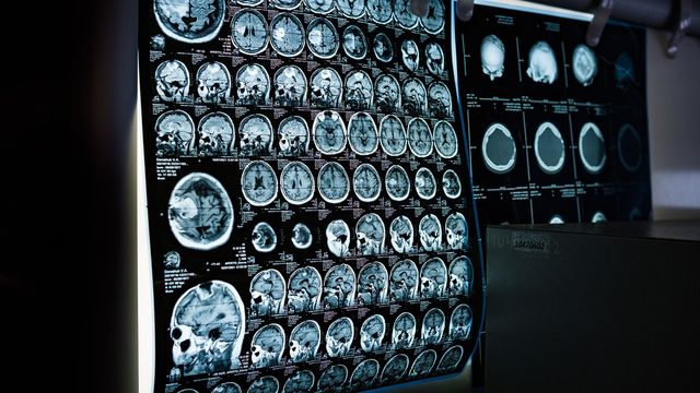 Type 2 Diabetes Linked to Functional and Structural Brain Changes ...