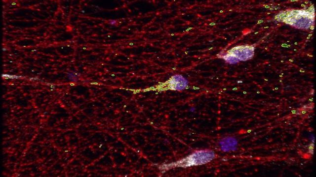 Fragile X Syndrome Begins in the Brain Before Birth | Technology Networks