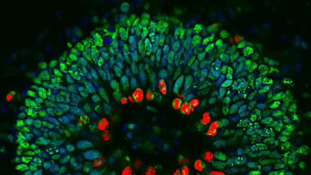 “Disease in a Dish” Model Sparks Hope for Early Intervention for ...