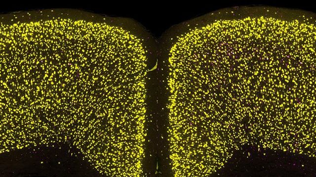 Lewy Bodies in Brain Cells Reveal Parkinson’s Disease Insights ...