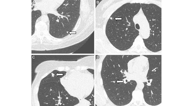 Solid Lung Nodules Found In 42 Of Non Smokers Technology Networks 9862