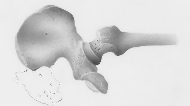 3D-Printed Femur Improves Surgical Planning and Training | Technology ...